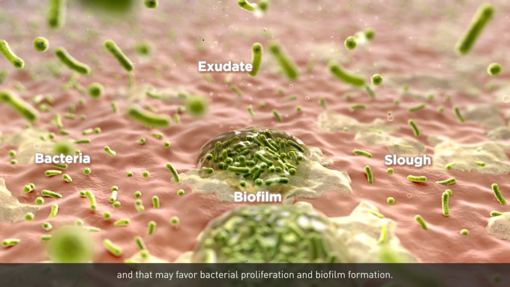 Urgo Medical | UrgoClean Ag chronic wound dressings