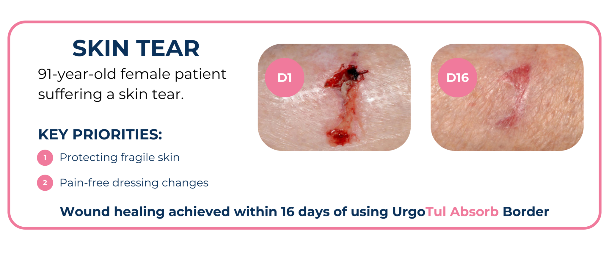 Urgo Medical | Skin Tears